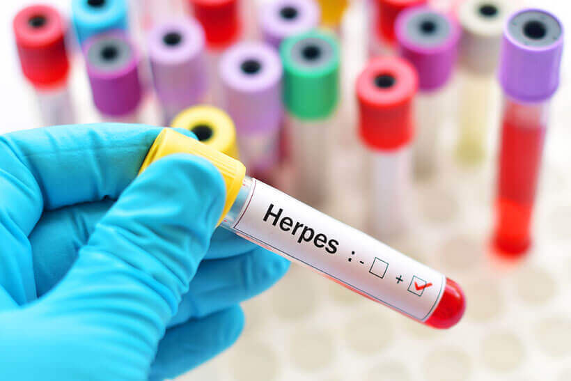 Best Herpes Tests Of 2019 (UPDATED Nov. 2019)